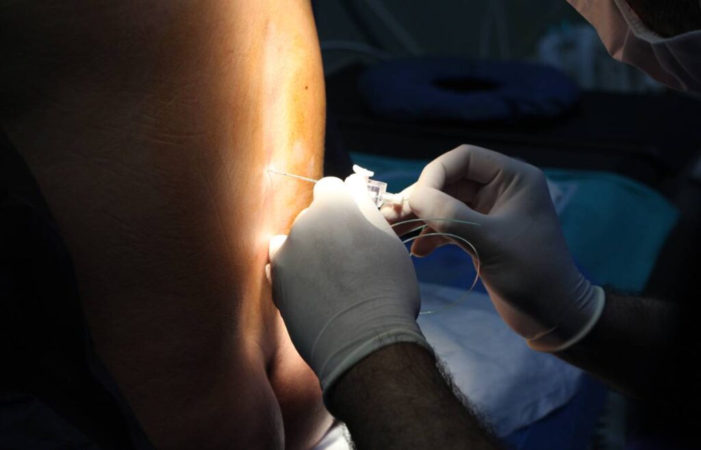 Methods to Test the Success of Epidural Anesthesia - Columbus ...